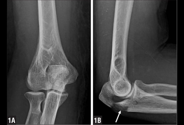 Fractures of the olecranon | PPT