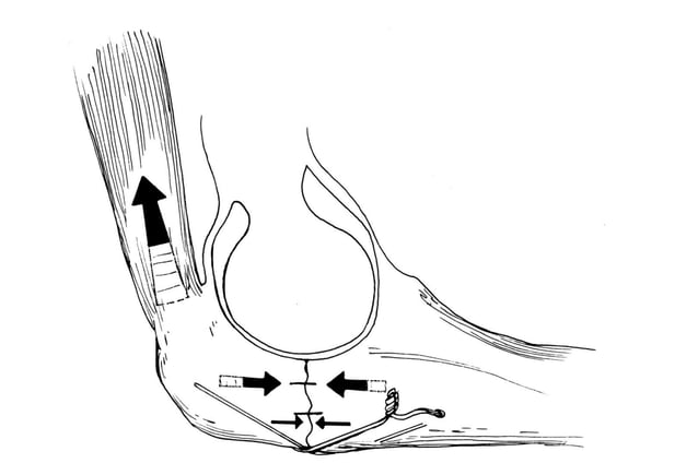 Fractures of the olecranon | PPT