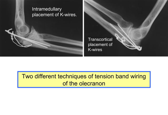 Fractures of the olecranon | PPT