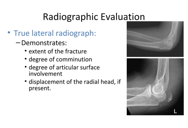 Fractures of the olecranon | PPT
