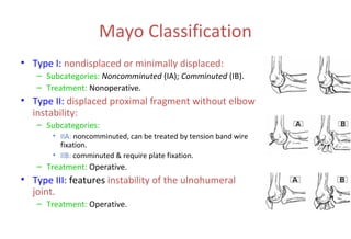 Olecranon Fracture Classification