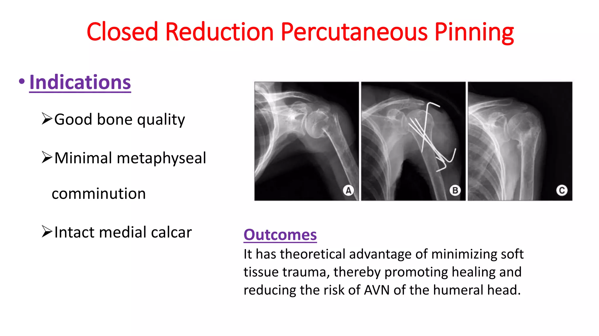 Fractures of the proximal humerus | PPTX