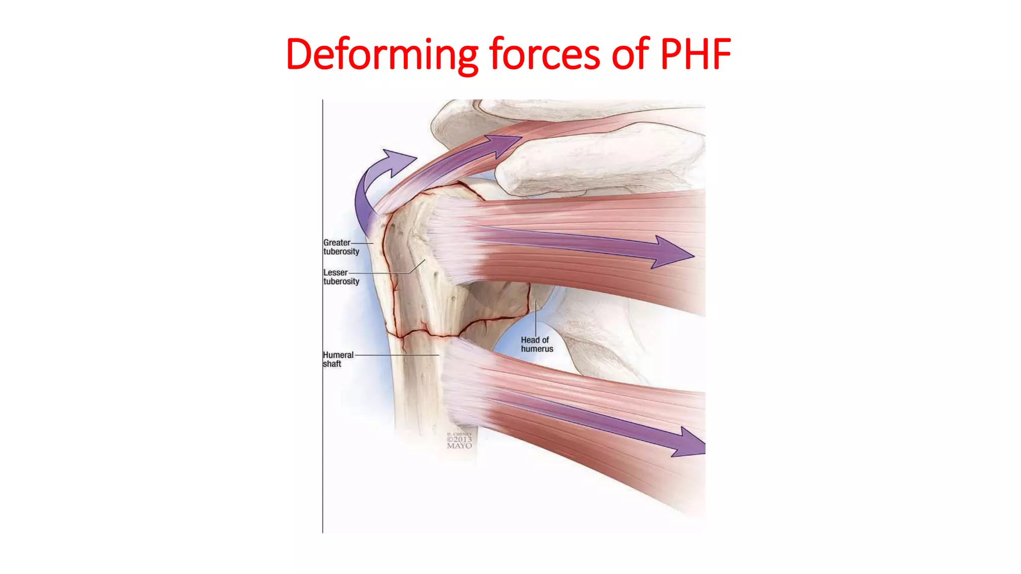 Fractures of the proximal humerus | PPTX