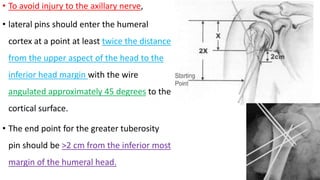 Fractures of the proximal humerus | PPT