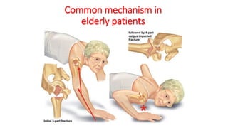 Mechanisms Of Humeral Head Fracture