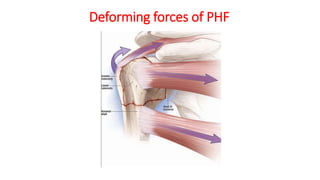 Fractures of the proximal humerus | PPTX