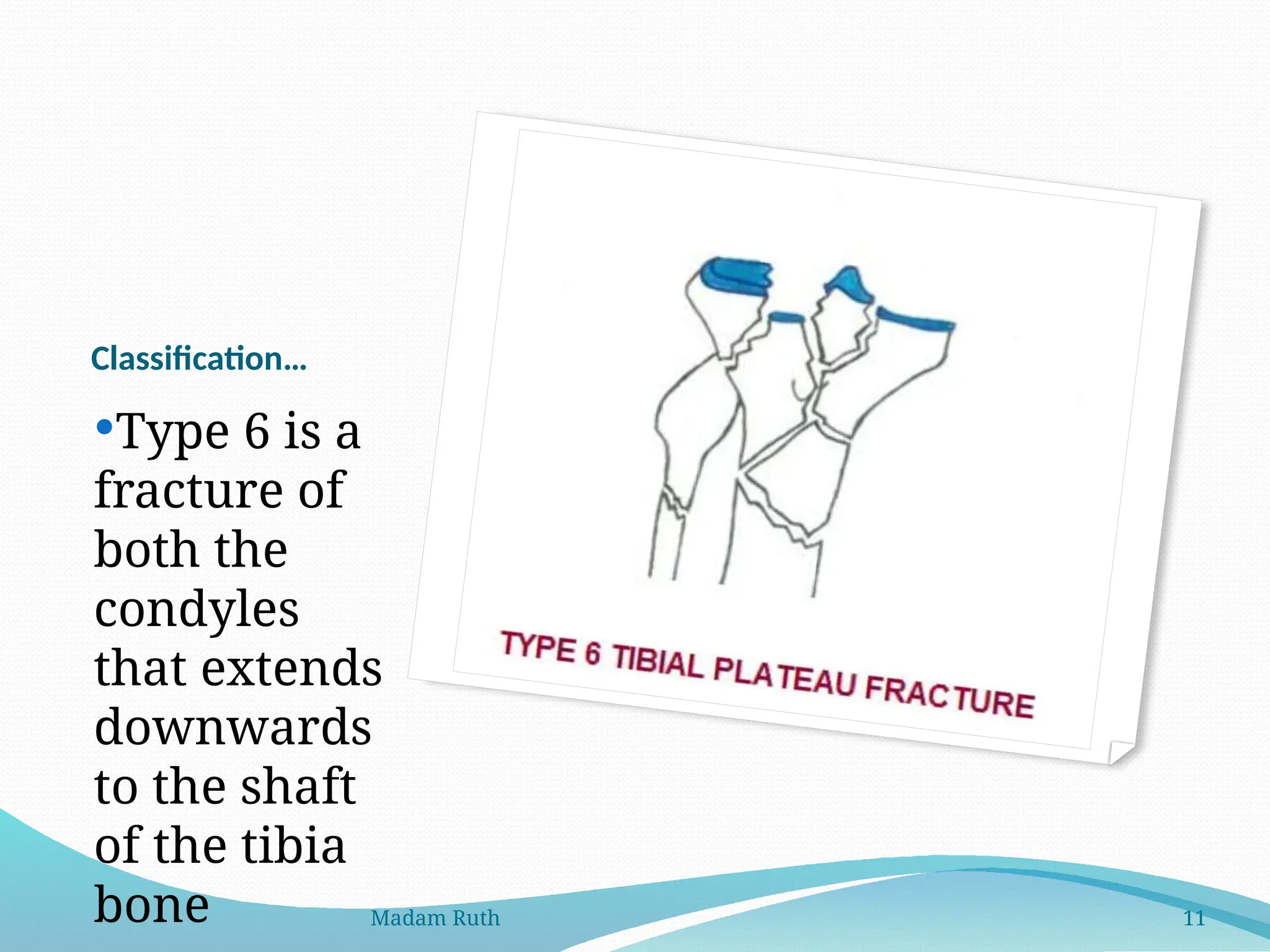FRACTURES OF THE TIBIA AND FIBULA-1.pptx