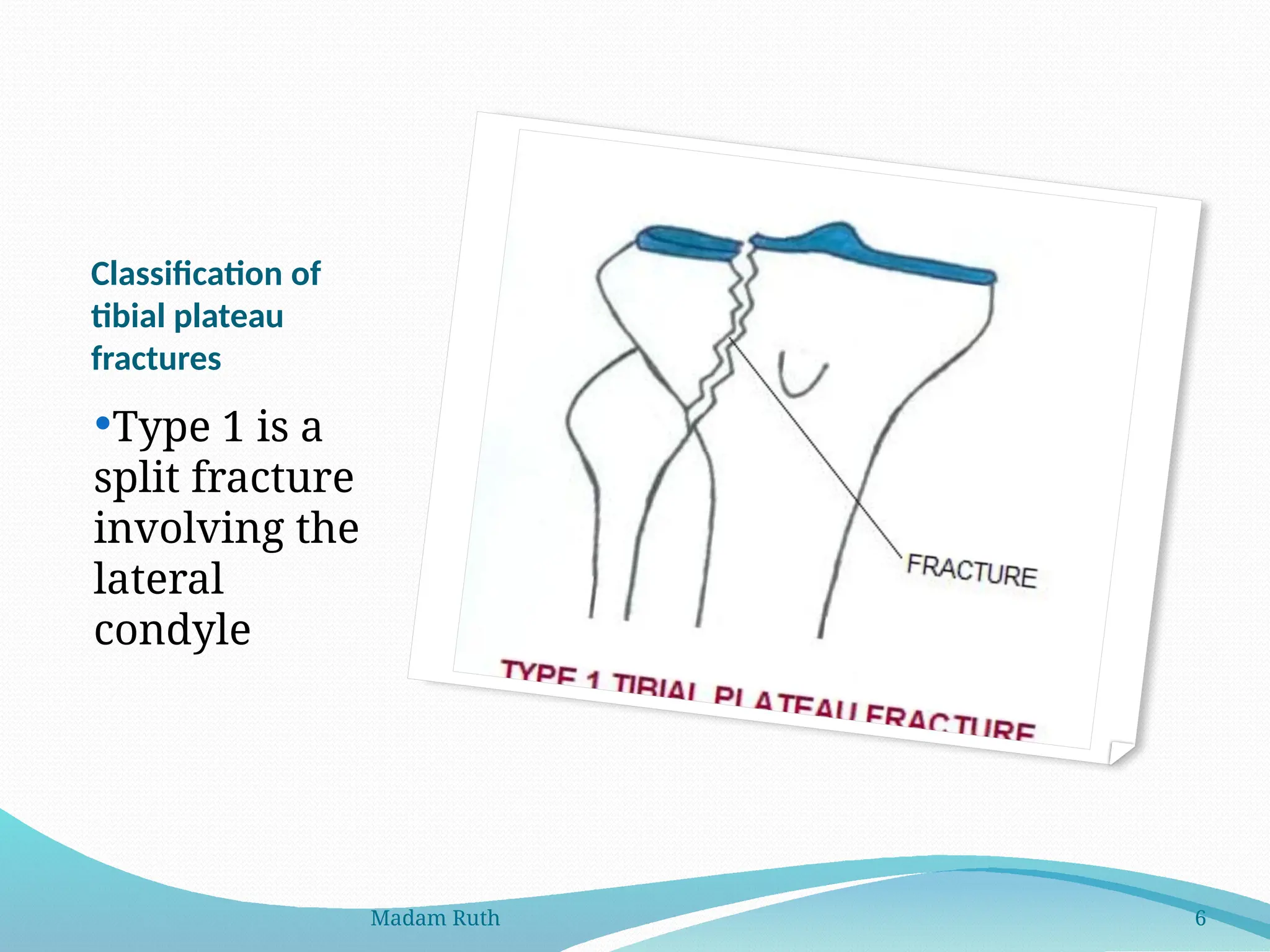 FRACTURES OF THE TIBIA AND FIBULA-1.pptx