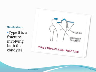 FRACTURES OF THE TIBIA AND FIBULA-1.pptx