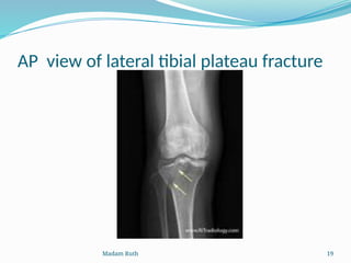 FRACTURES OF THE TIBIA AND FIBULA-1.pptx