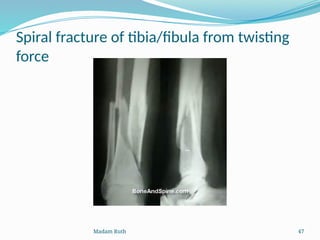 FRACTURES OF THE TIBIA AND FIBULA-1.pptx