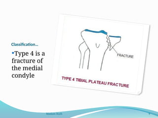 FRACTURES OF THE TIBIA AND FIBULA-1.pptx