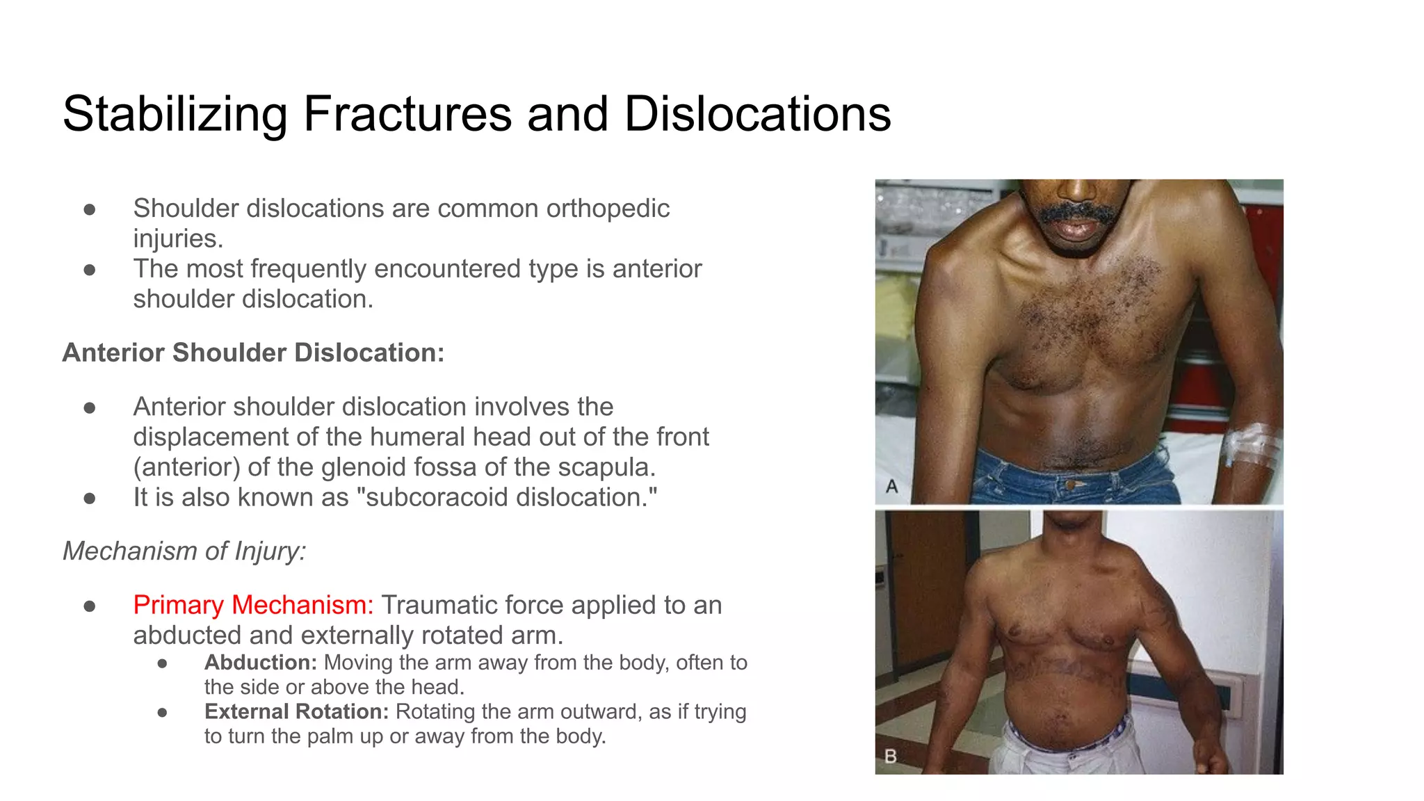 Fractures of the Upper Limb | PDF