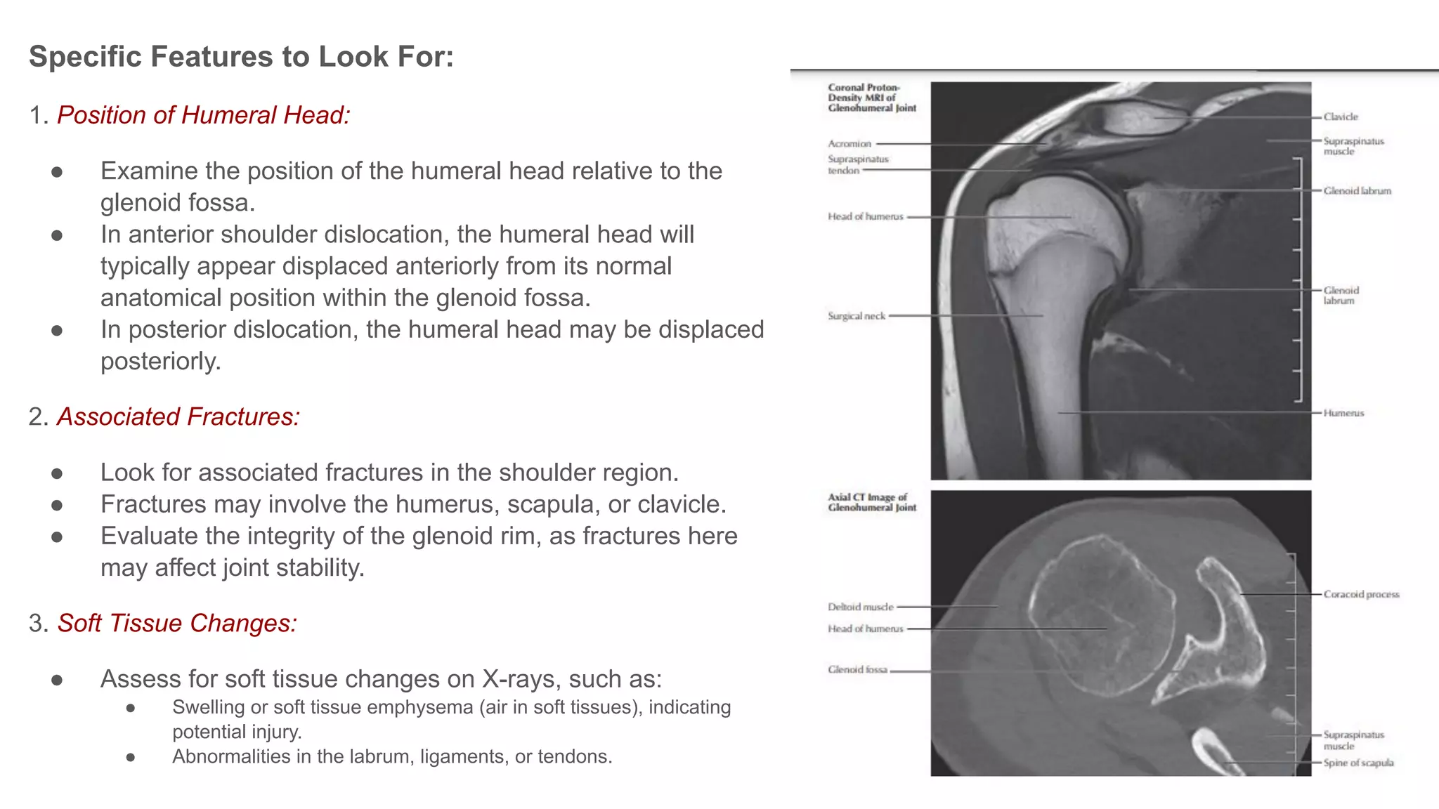 Fractures of the Upper Limb | PDF