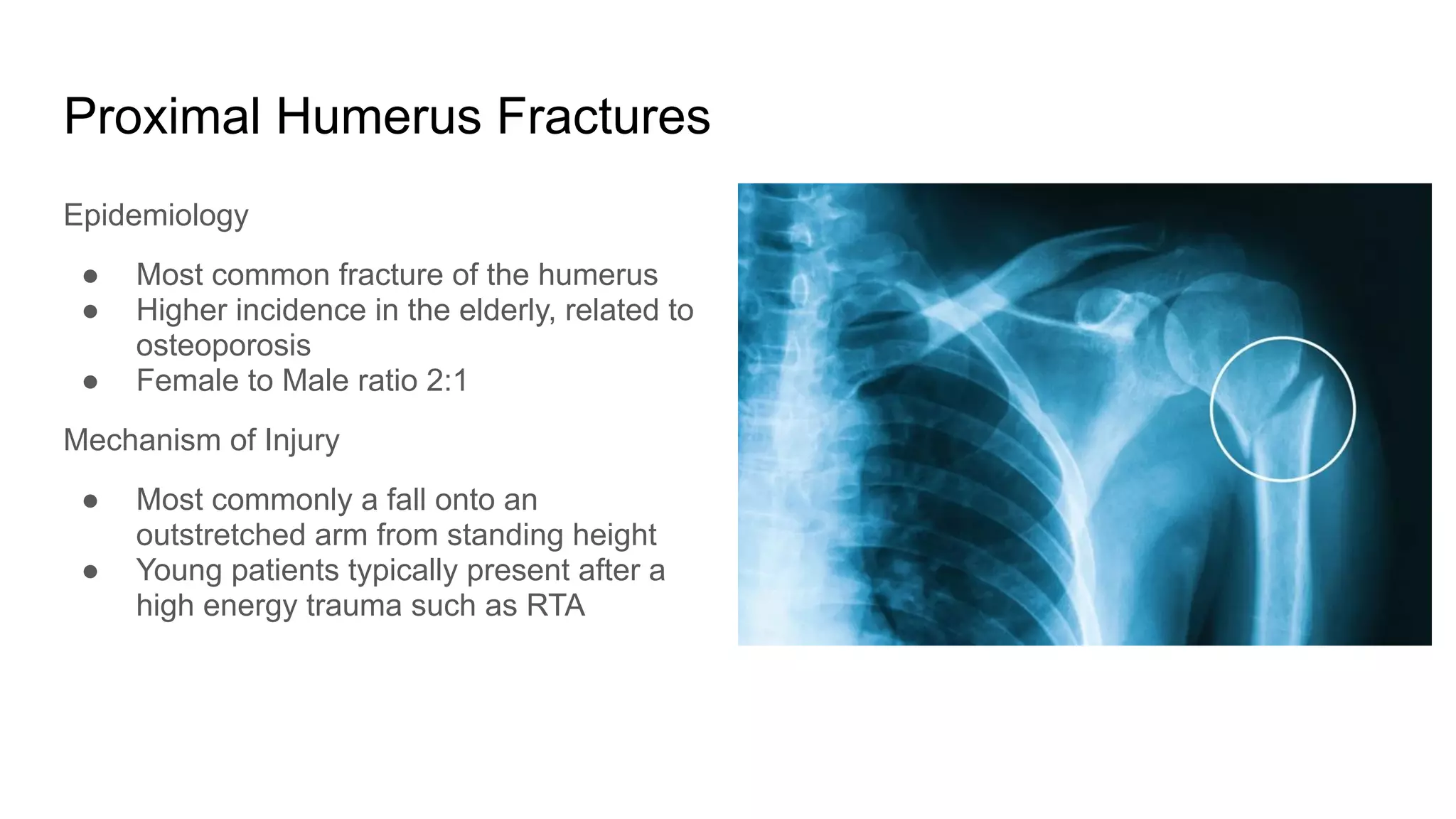 Fractures of the Upper Limb | PDF