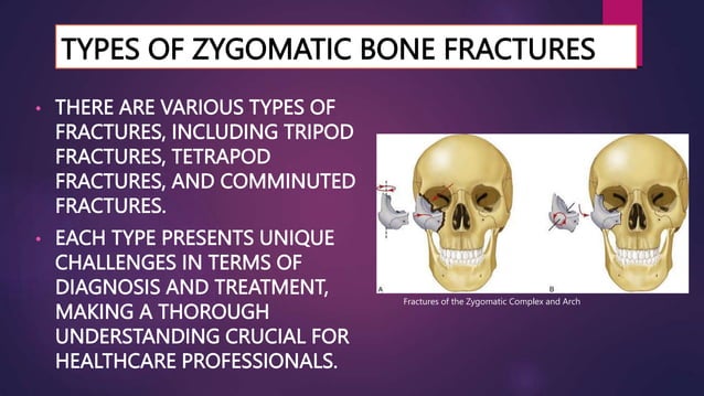 FRACTURES OF THE ZYGOMATIC BONE AND ZYGOMATIC ARCH.pptx