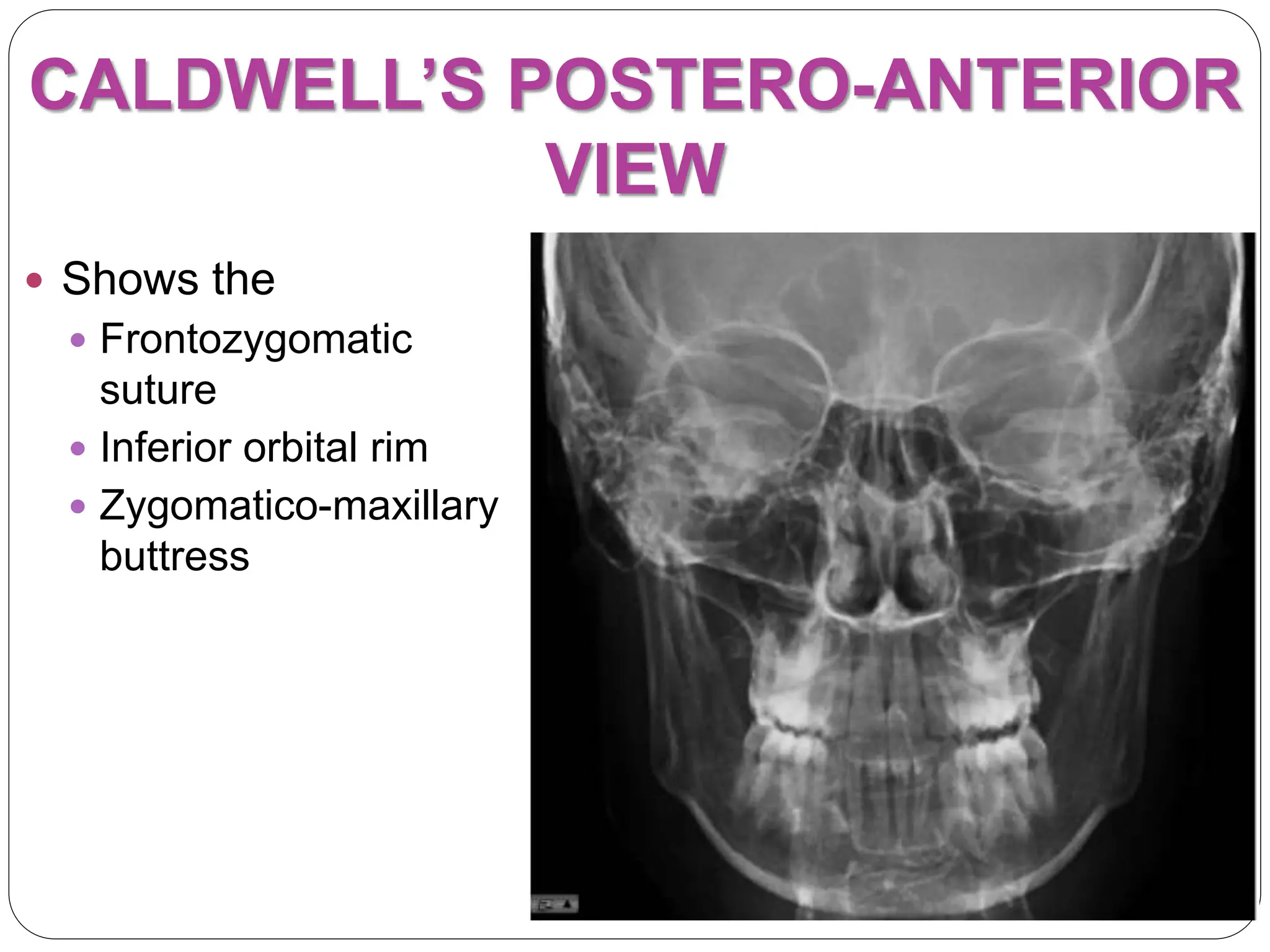FRACTURES OF THE ZYGOMATIC COMPLEX AND ORBIT.pptx.pptx