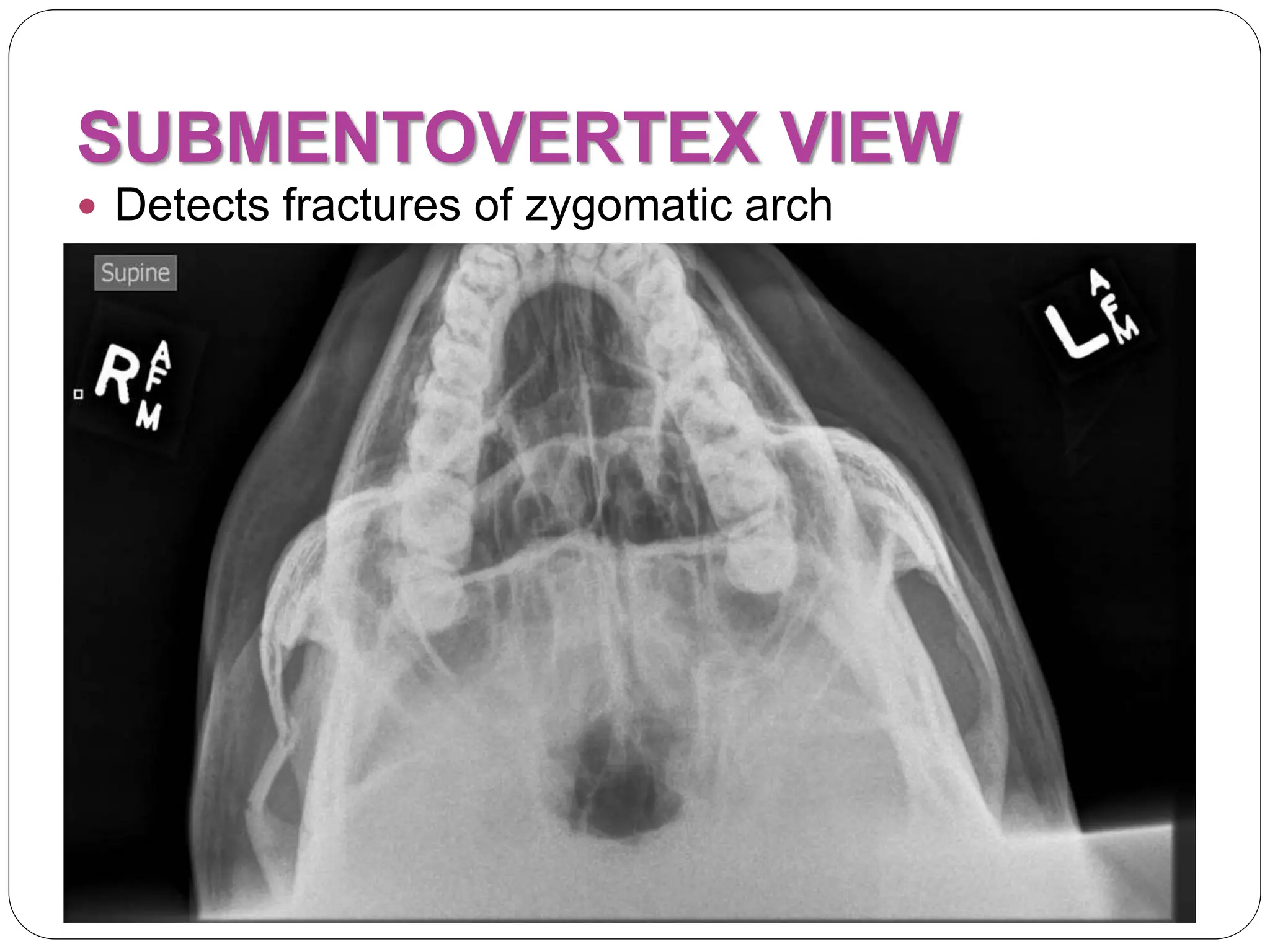 FRACTURES OF THE ZYGOMATIC COMPLEX AND ORBIT.pptx.pptx