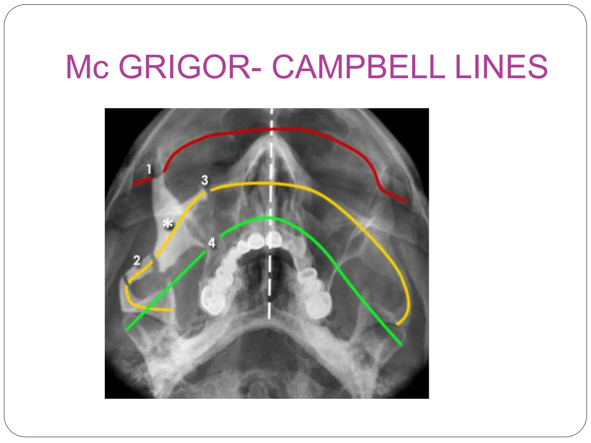 FRACTURES OF THE ZYGOMATIC COMPLEX AND ORBIT.pptx.pptx