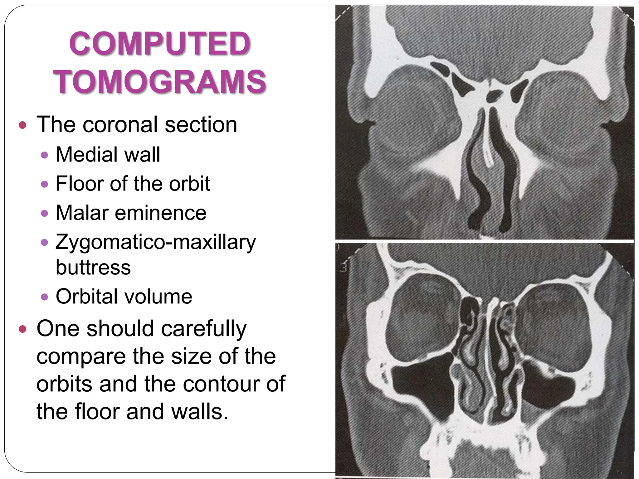 FRACTURES OF THE ZYGOMATIC COMPLEX AND ORBIT.pptx.pptx