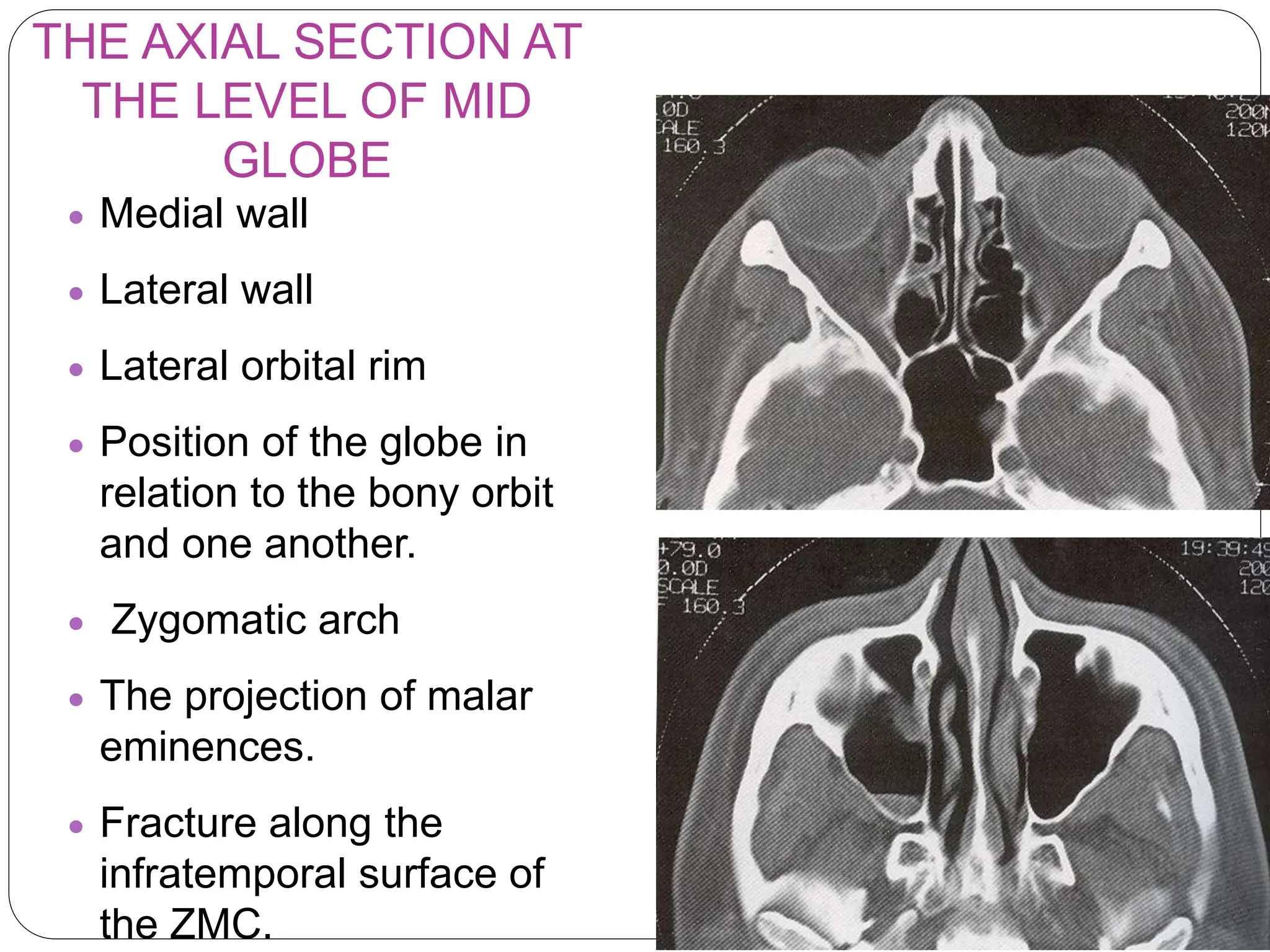 FRACTURES OF THE ZYGOMATIC COMPLEX AND ORBIT.pptx.pptx