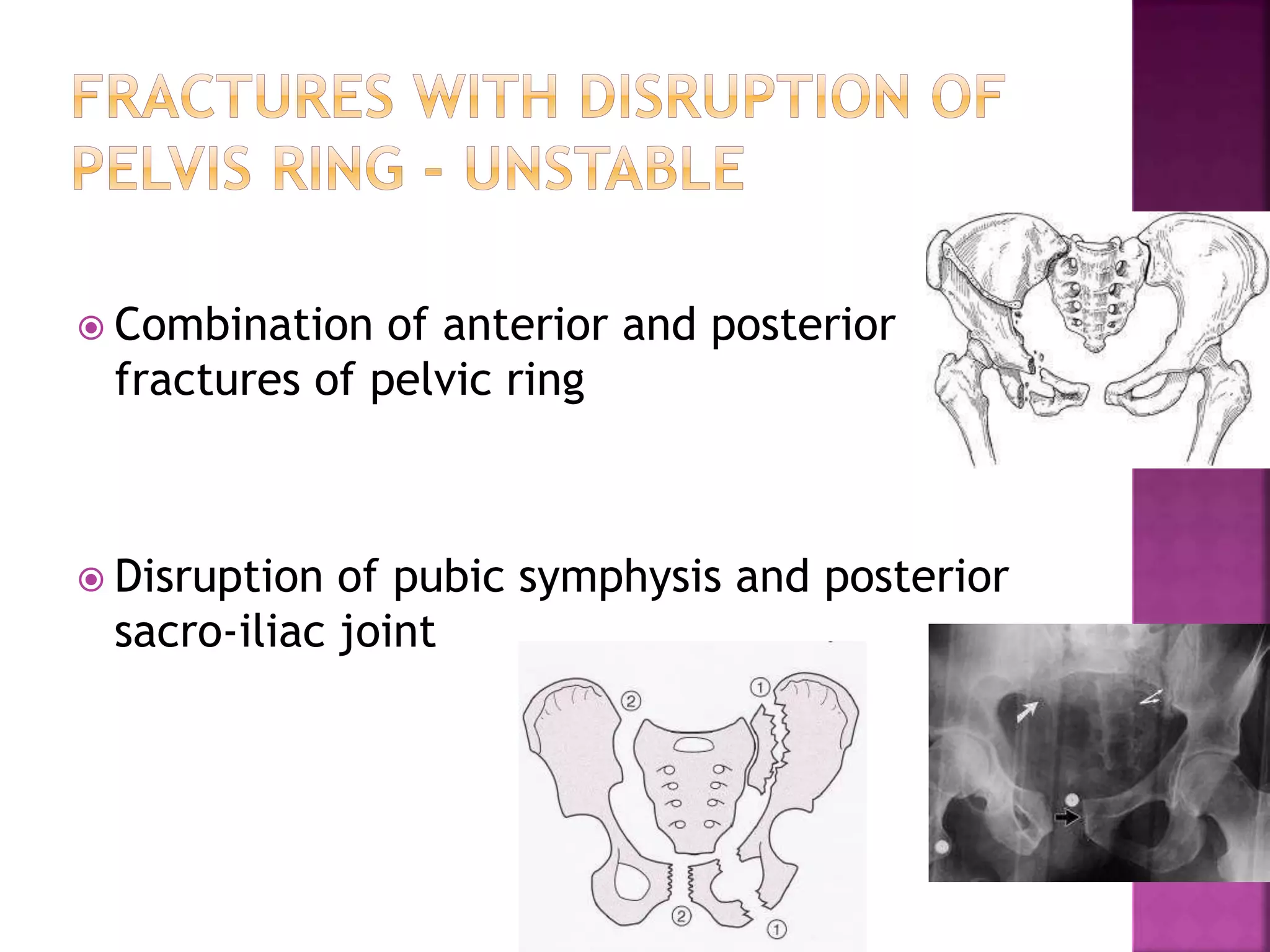 Fractures pelvis.pptx