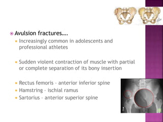 Fractures pelvis.pptx