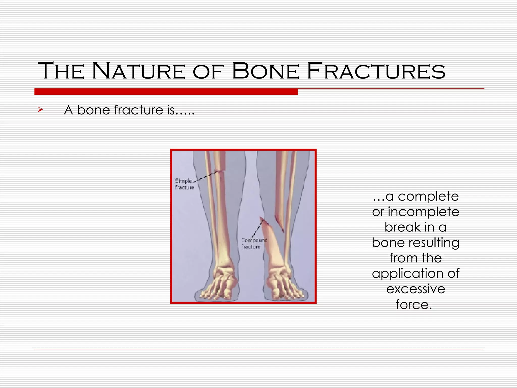 Fractures | PPT