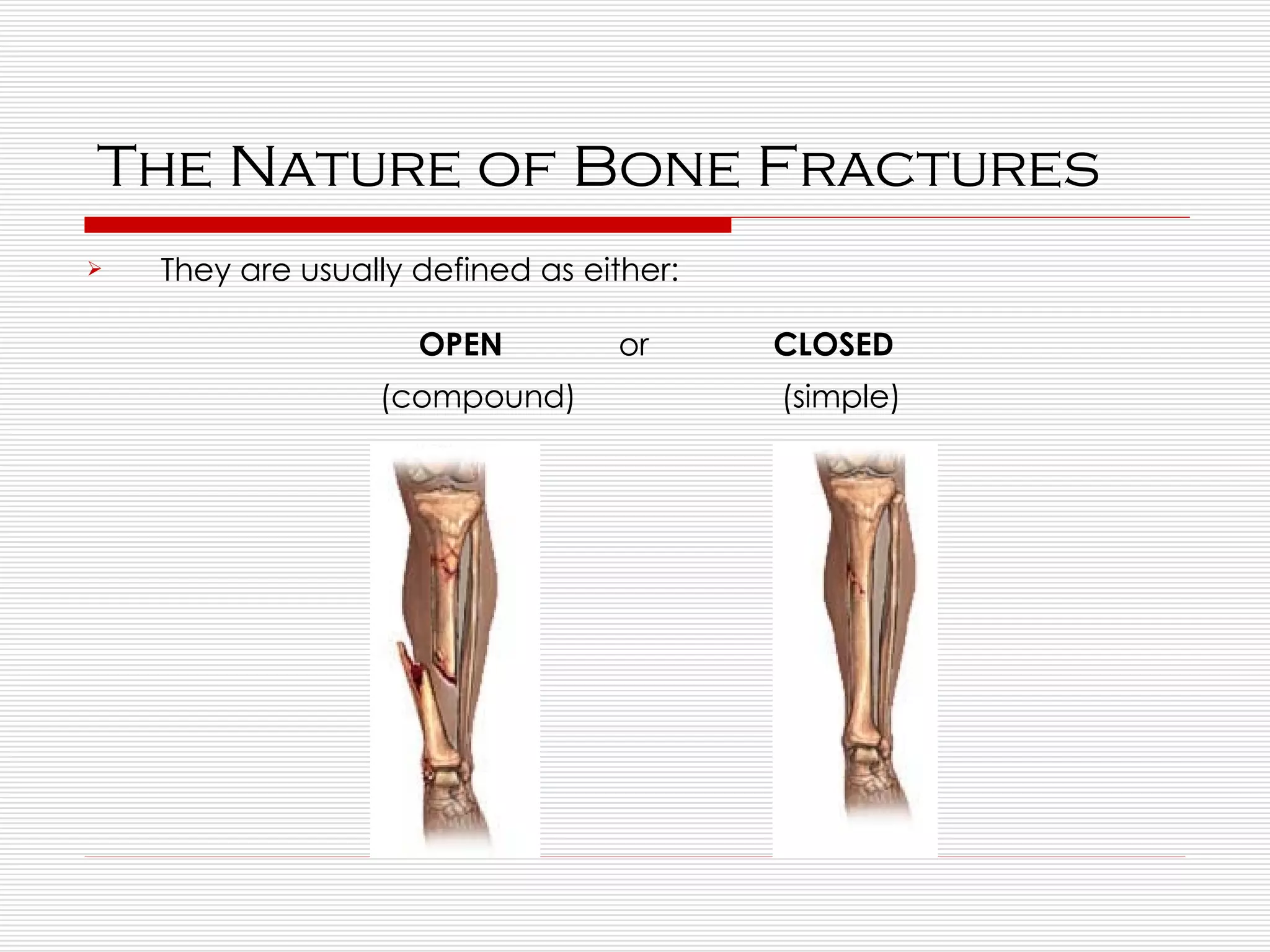 Fractures | PPT