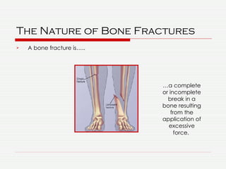 Fractures | PPT