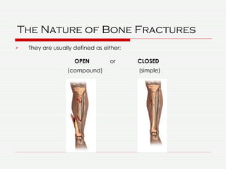 Fractures | PPT