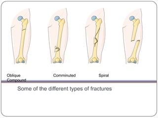Fractures Presentation | PPTX