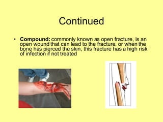 Fractures | PPT | Death, Injury, or Military Conflict | Sensitive Topics