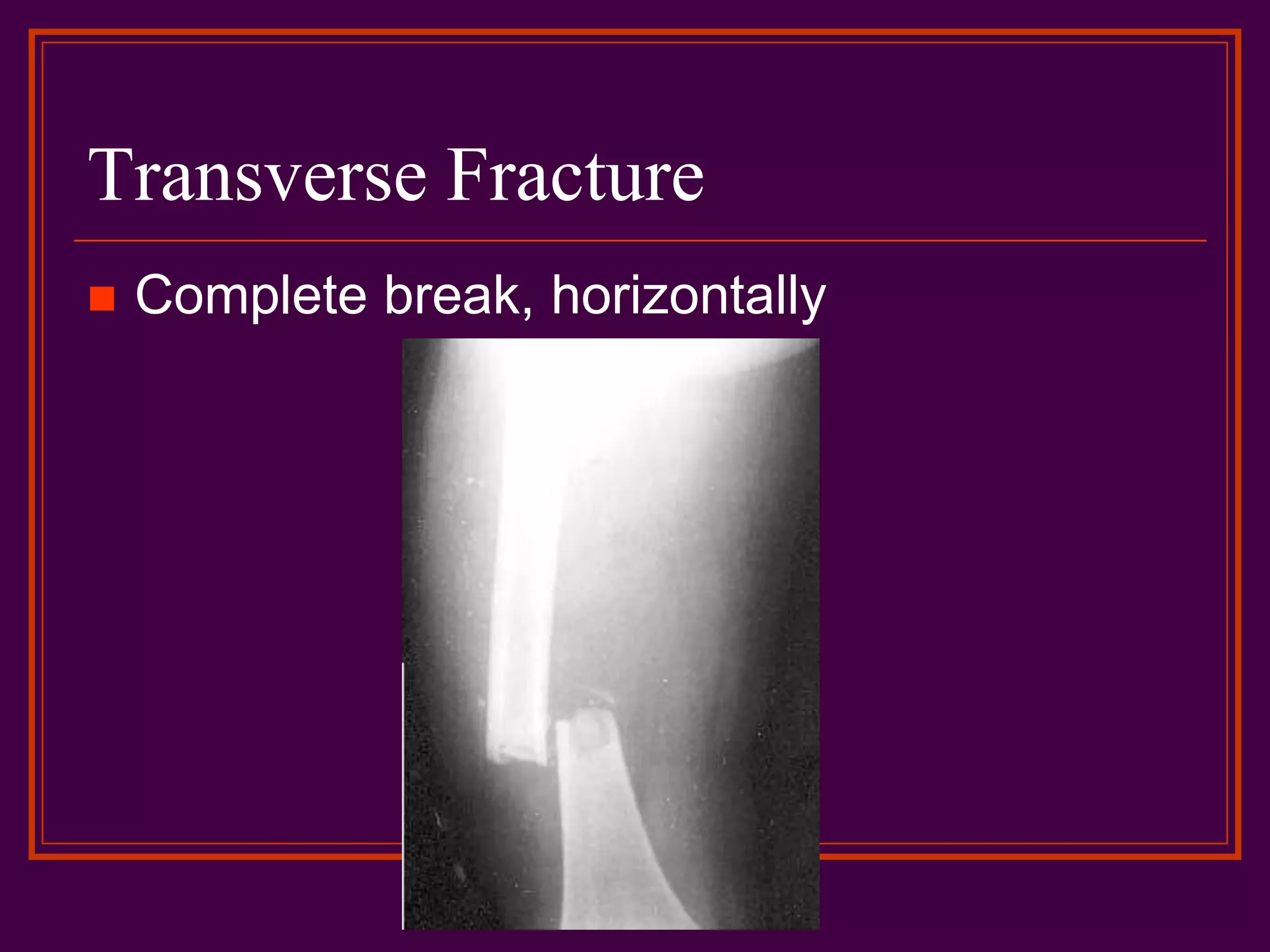Fractures & Skeletal Conditions | PPTX