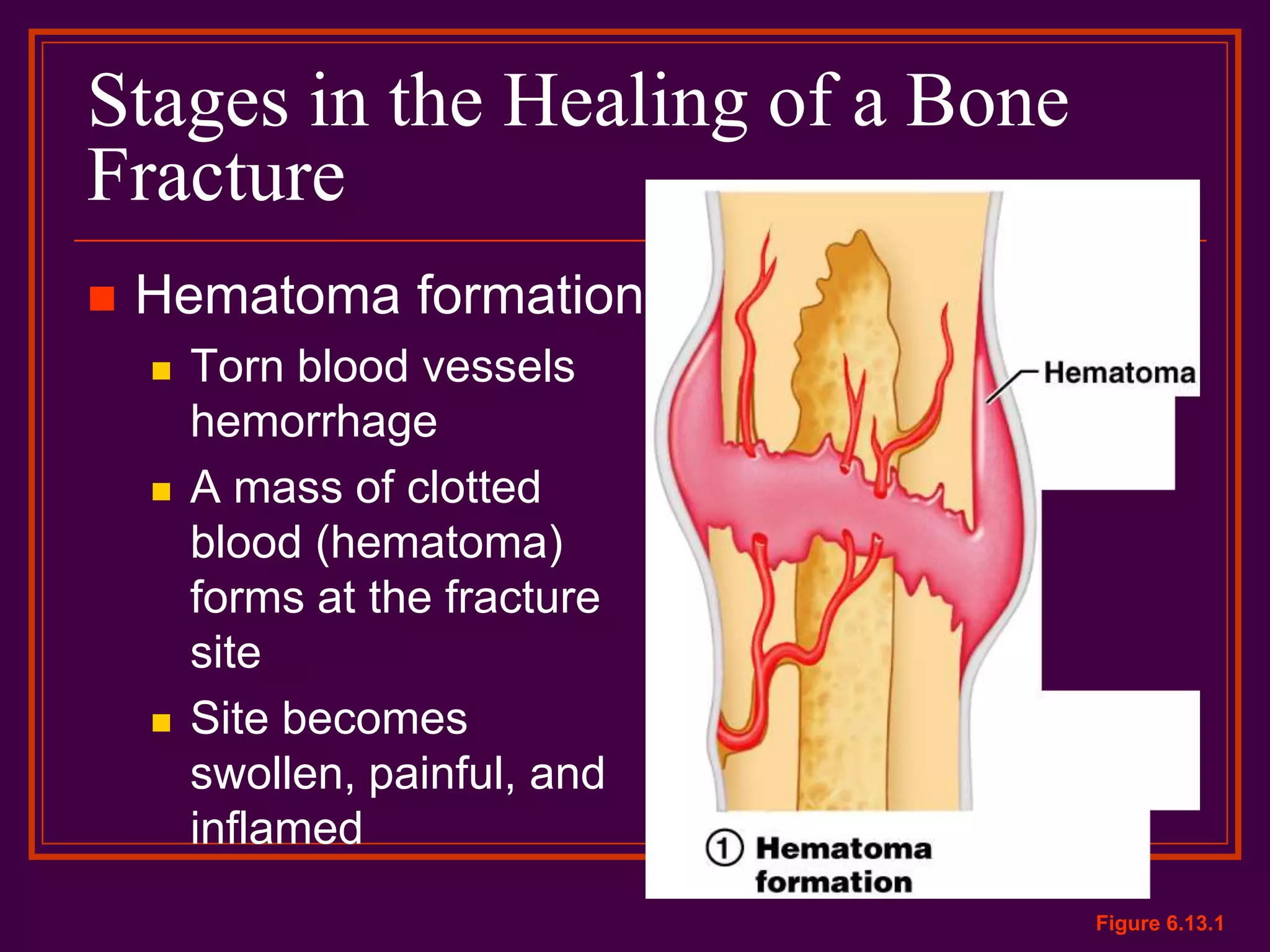 Fractures & Skeletal Conditions | PPT Fractures & Skeletal Conditions | PPT