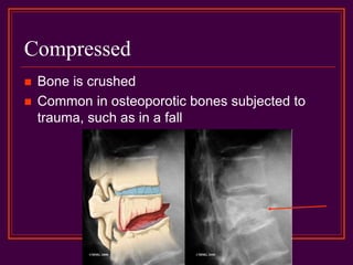 Fractures & Skeletal Conditions | PPT