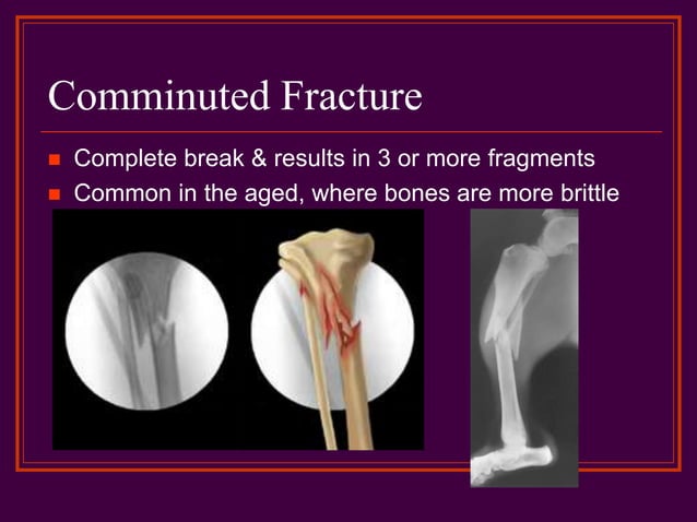 Fractures & Skeletal Conditions | PPT