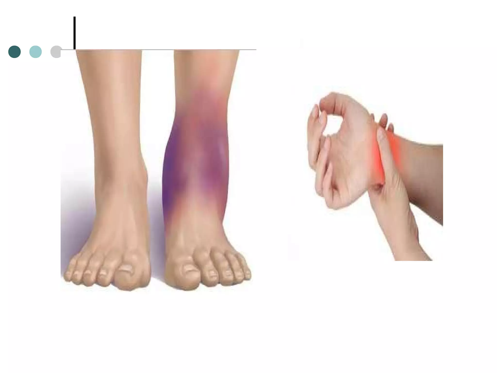 Fractures sprains and dislocations | PPS