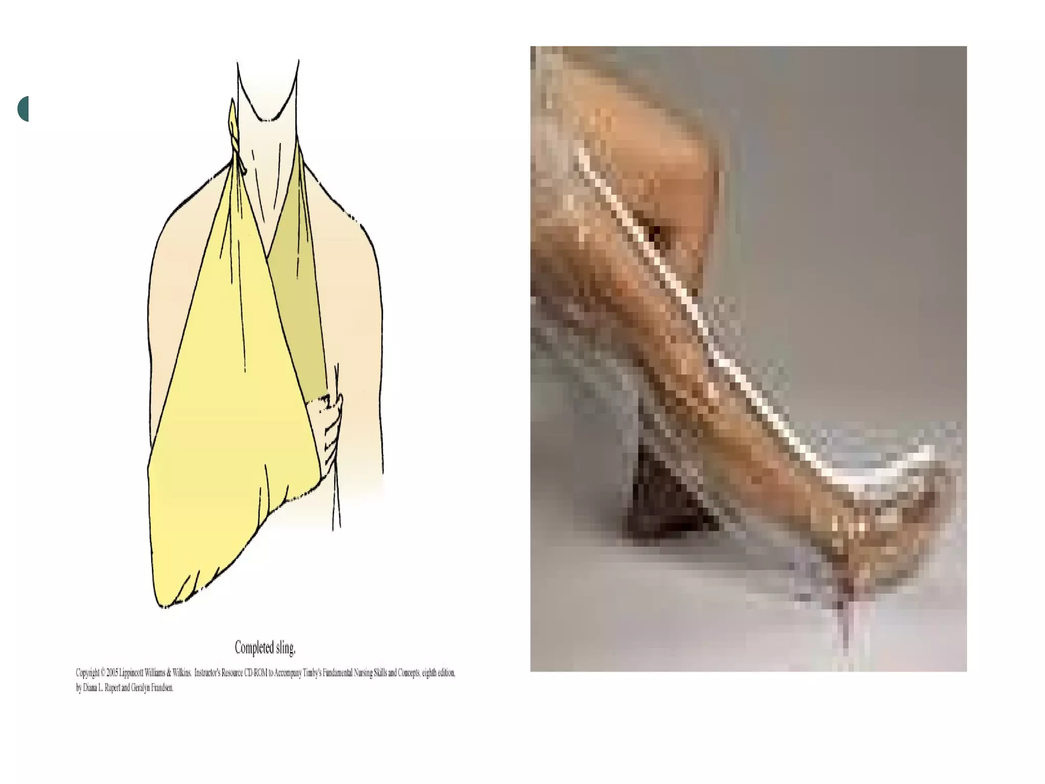 Fractures sprains and dislocations | PPS