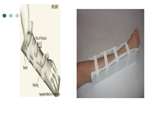 Fractures sprains and dislocations | PPS | First Aid | Injuries