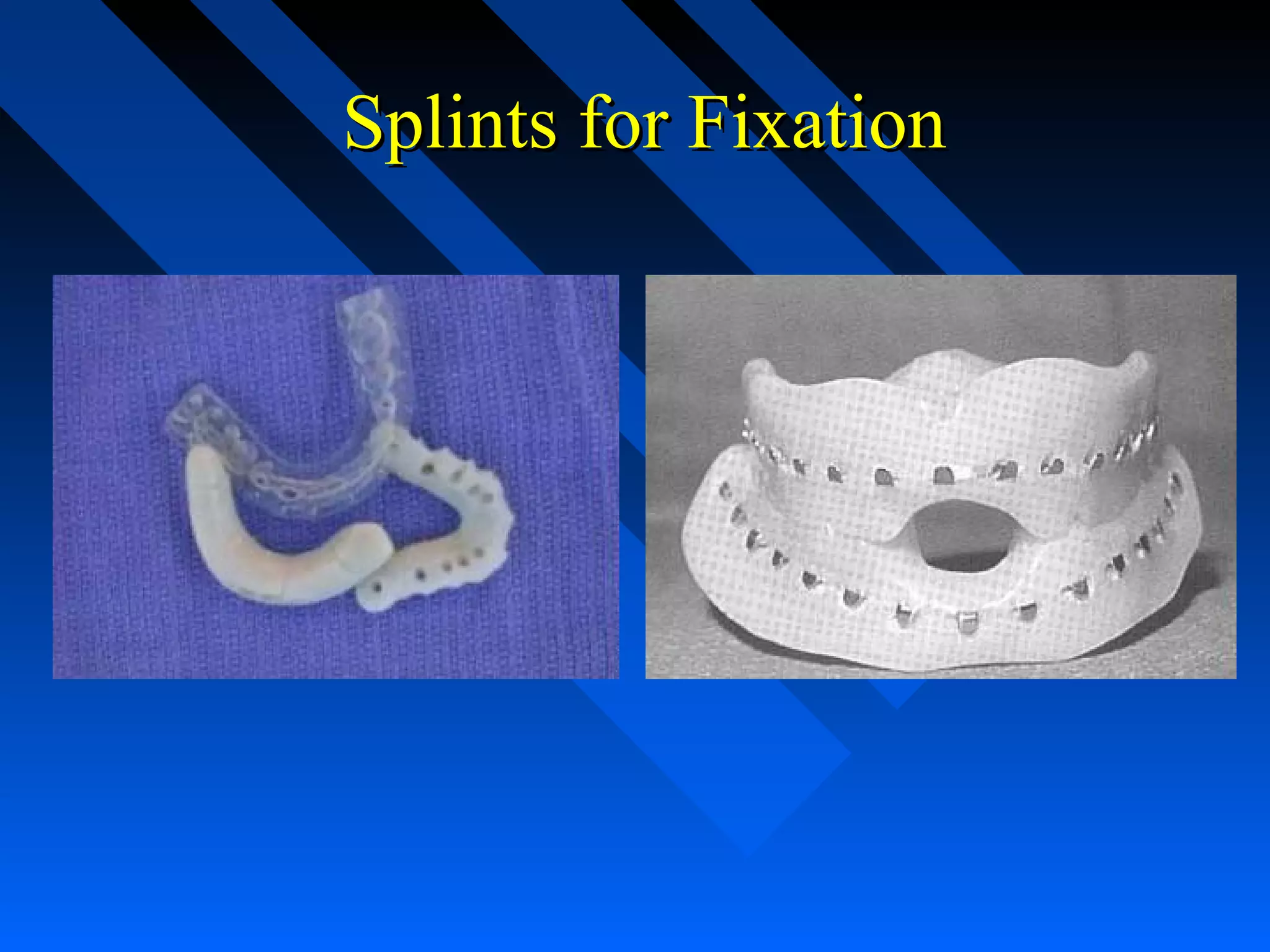 Fracture stabilization | PPT
