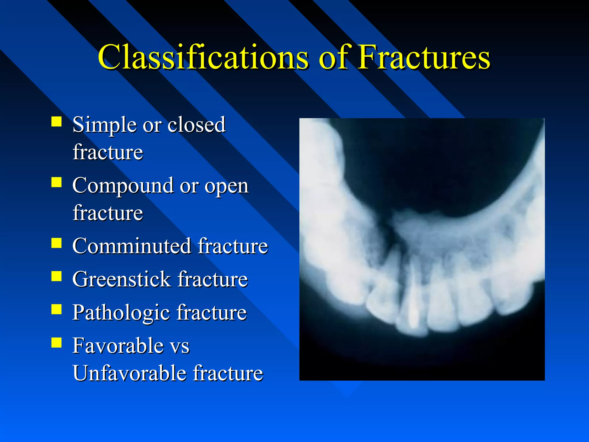 Fracture stabilization | PPT