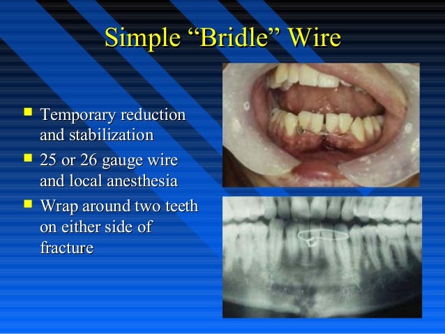 Fracture stabilization