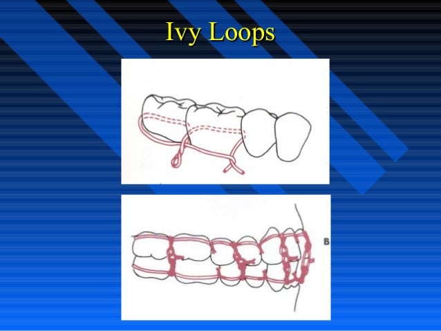 Fracture stabilization