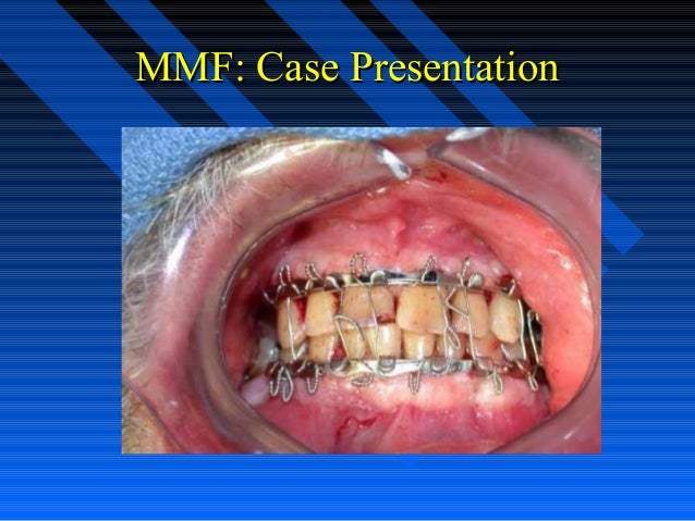 Fracture stabilization