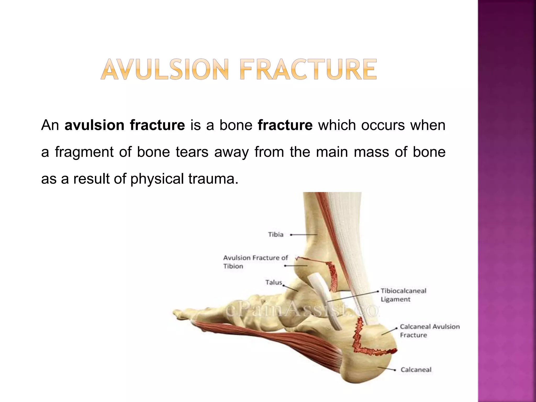 Fractures and types | PPTX