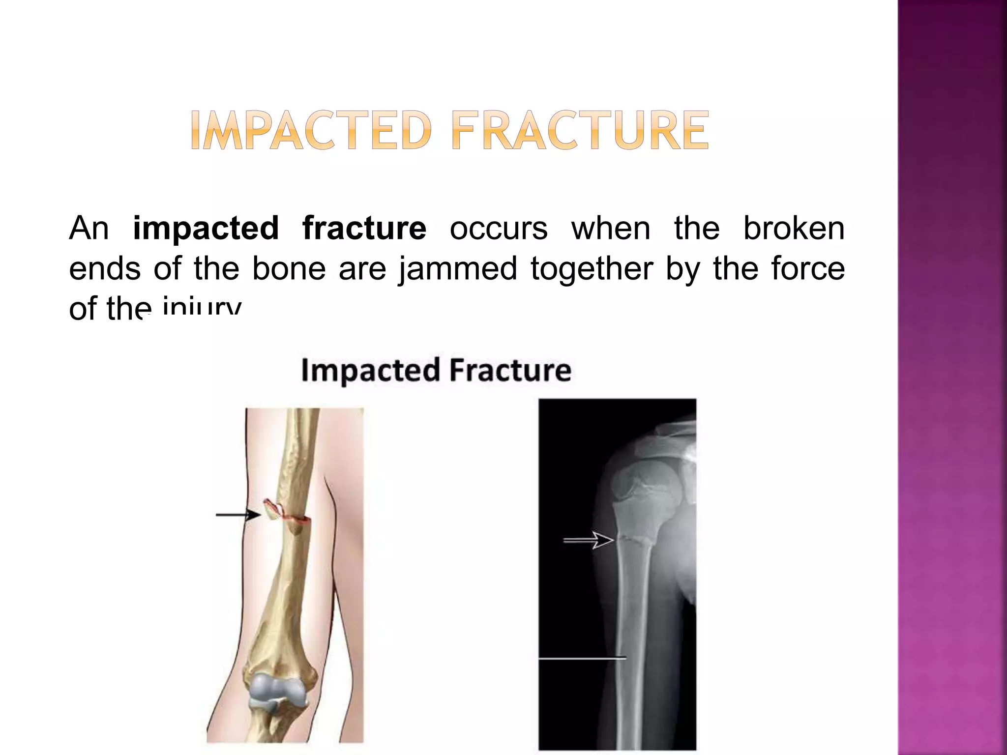 Fractures and types | PPTX