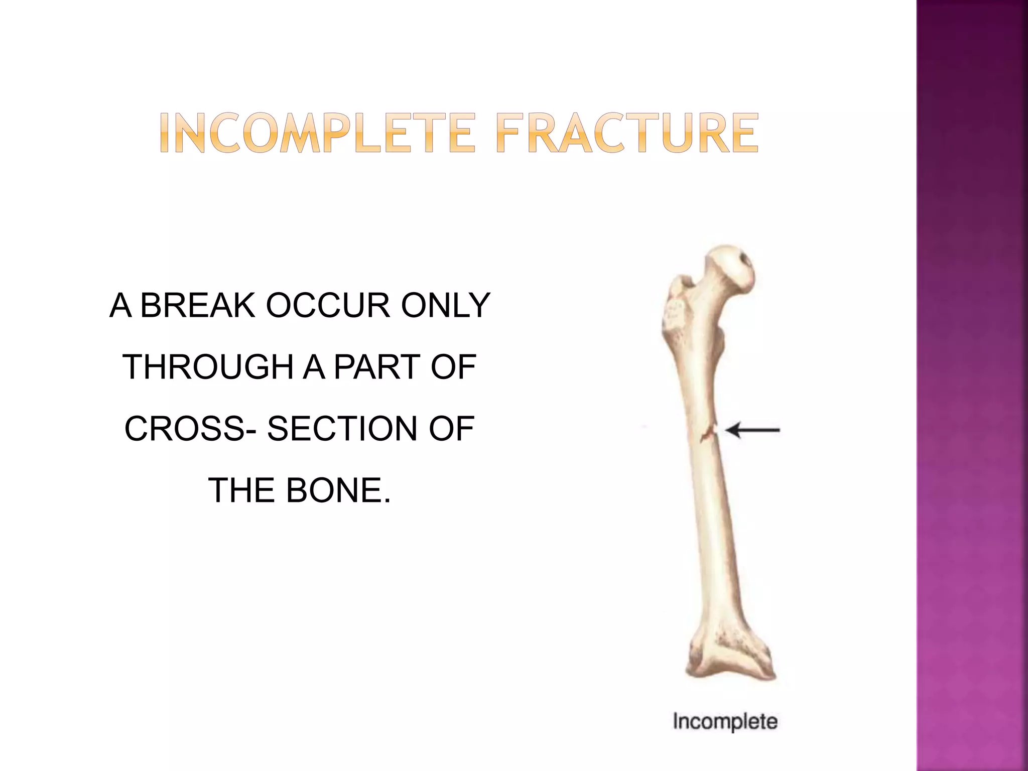 Fractures and types | PPTX