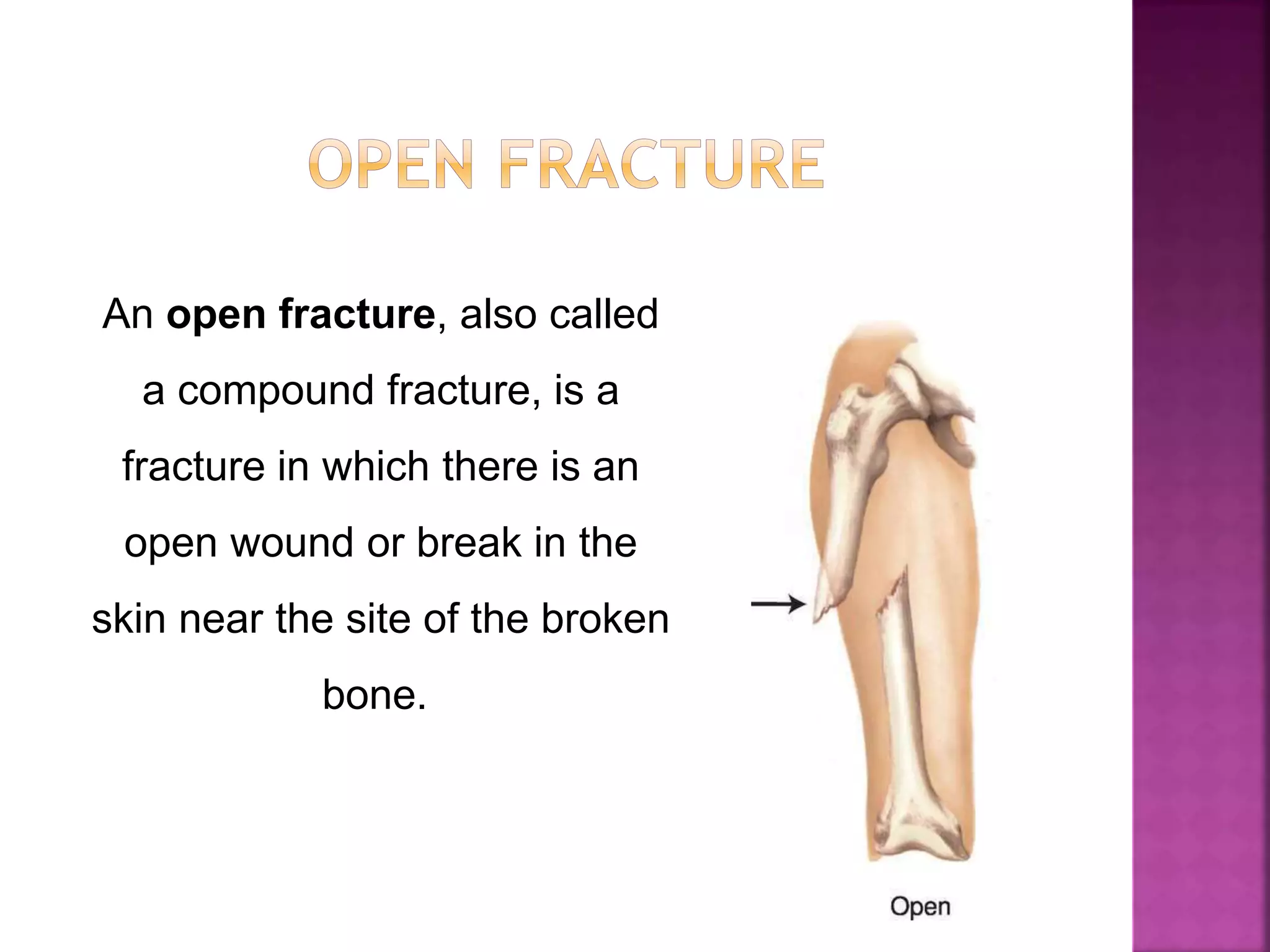 Fractures and types | PPTX