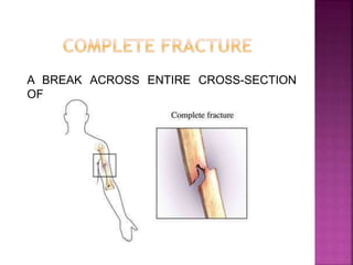 Fractures and types | PPTX